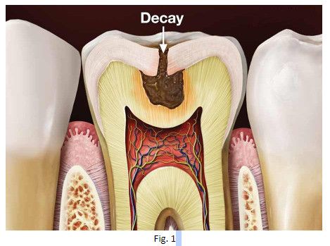 Tooth Decay Causes